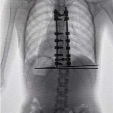 Measurement Of Apical Vertebral Rotation Angle Ct Spine Axial View