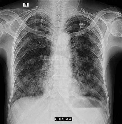 349 Cxr Radiography Royalty Free Photos And Stock Images Shutterstock