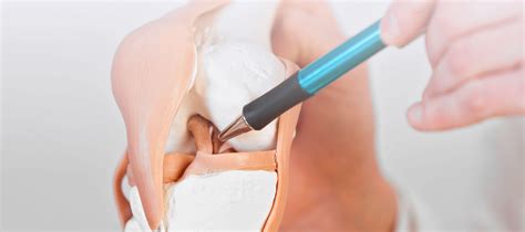 Top Tips For Acl Rehab Masterclass By Top Expert Bart Dingenen