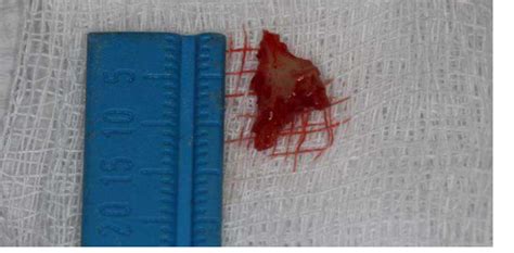 Excised Bone Sequestrum Removal Of The Bone Sequestrum Did Not Require Download Scientific