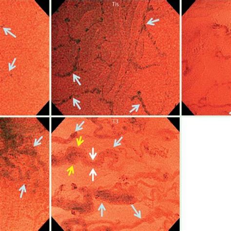 Images Obtained By Endocytoscopy With Narrow Band Imaging Ec Nbi At