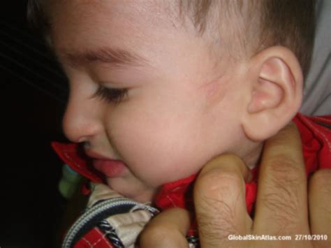 Global Skin Atlas Diagnosis Detail