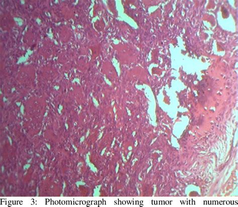Figure 1 From Giant Cell Tumor Of Metacarpal Bone With Aggressive