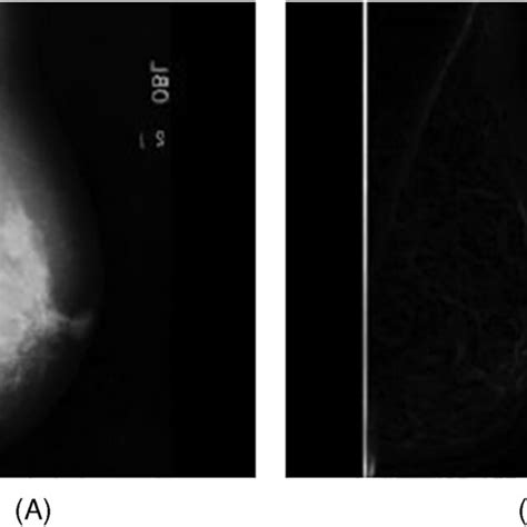 Gabor Multi Resolution Mammogram Image Download Scientific Diagram