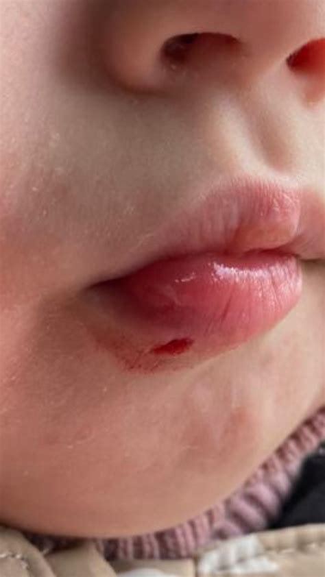 Syn Padol Na ústa Je Potrebné Ranu Zašiť Modrý Koník