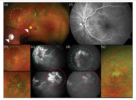 Figure 1 From Peripheral Retinal Neovascularization In A Patient With Pilocytic Astrocytoma