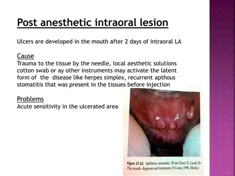 Complications Of Local Anesthesia Pptx