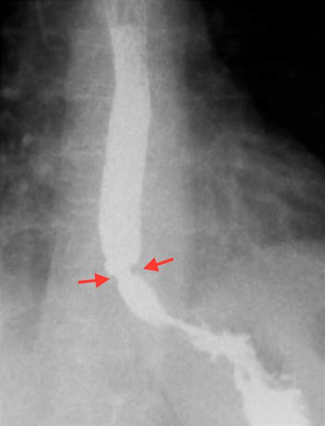 Complete Esophageal Obstruction Following Endoscopic Variceal Ligation