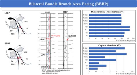 Bilateral Bundle Branch Area Pacing To Achieve Physiological Conduction System Activation