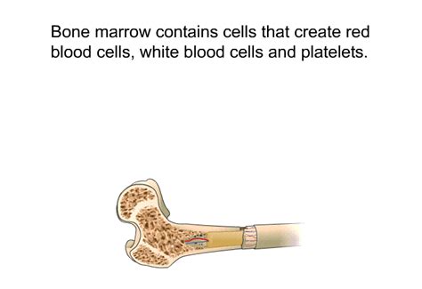 Pagets Disease Of Bone