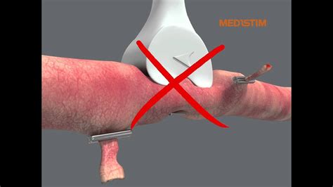 Flow And Probe Placement YouTube