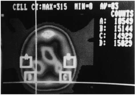 Temporal Lobe Rois Used For The Determination Of Ai And Number Of Rois