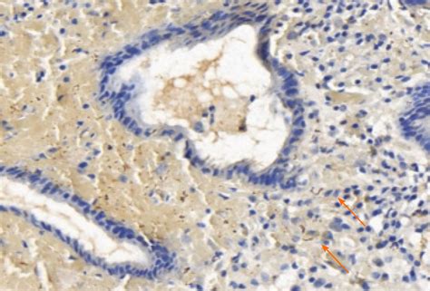 Numerous Spirochetes Were Observed By Immunohistochemical Staining