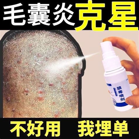 Scalp Folliculitis Before And After Chest Seborrheic Dermatitis Scalp Itching Erythema Itching