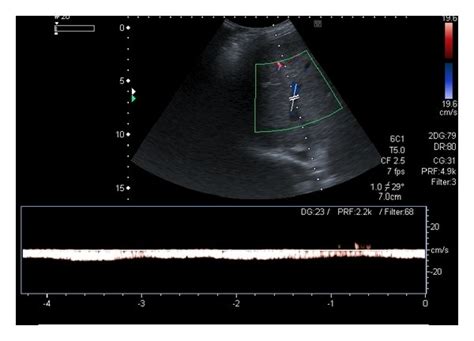 Spectral Doppler Image In A Patient With Bcs Shows Monophasic Waveform Download Scientific