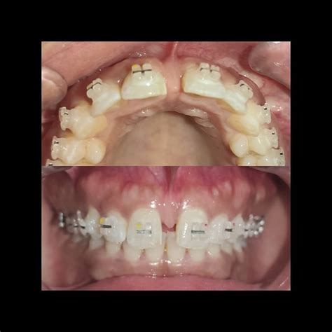 Dr Muhammad Uzair A Thick Wide Maxillary Labial Frenum Attached