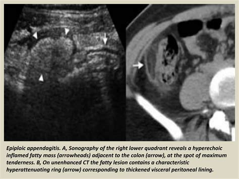 Presentation1 Pptx Ultrasound Examination Of The Appendix Pptx