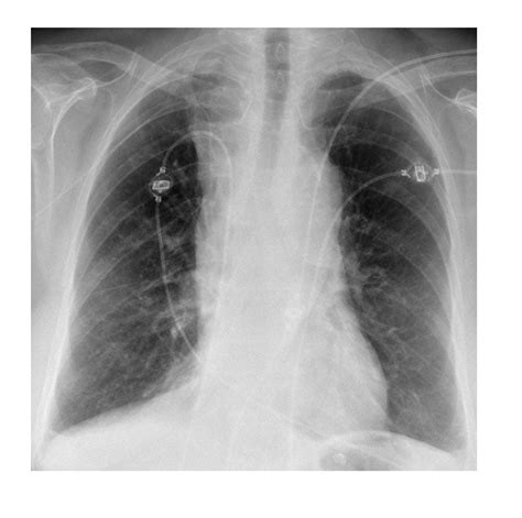 Frontal Cxr Emergucate