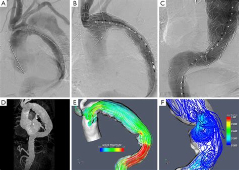 Thoracic Endovascular Aortic Repair Tevar Of A Type B Aortic