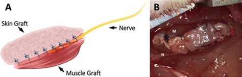 Regenerative Peripheral Nerve Interfaces Rpnis An Overview Of