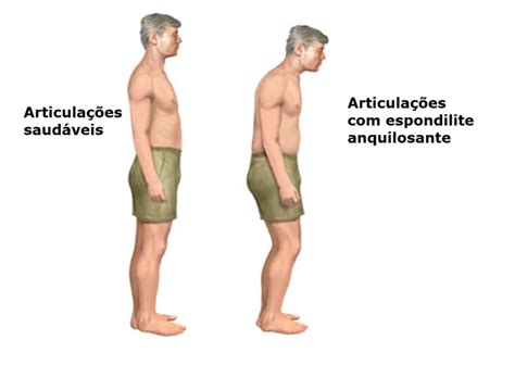 Espondilite Anquilosante Conheça Os 16 Sintomas Dr Thiago Rodrigues