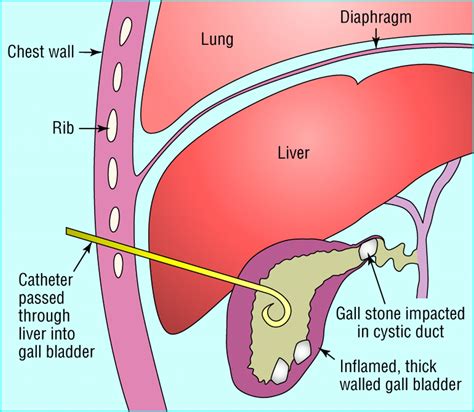 Percutaneous Drainage Of Gallbladder Best Drain Photos Primagem Org