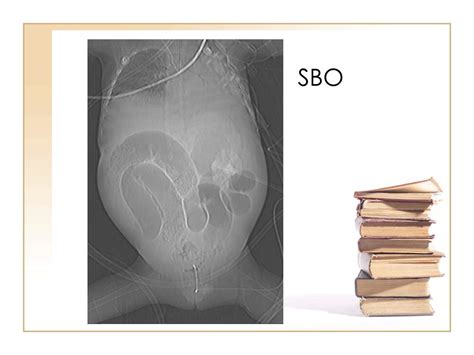 Ppt Bowel Obstruction Powerpoint Presentation Free Download Id3378275