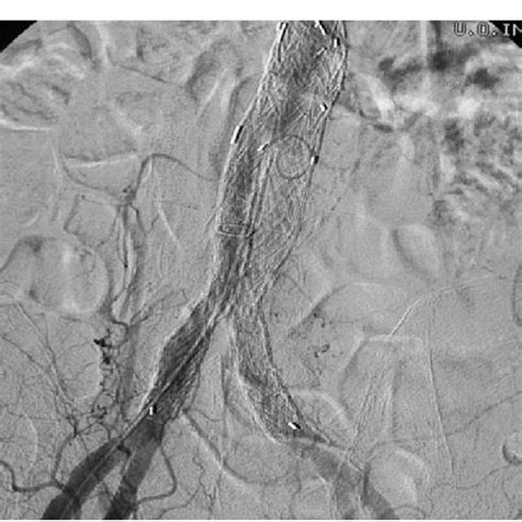 Cps Ultrasound Exam Detection Of Type Ii Endoleak Fig From Video