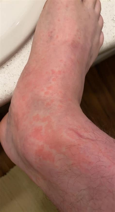 Puffy After It Started Itchy Ignore The Scab That Was Done From Moving