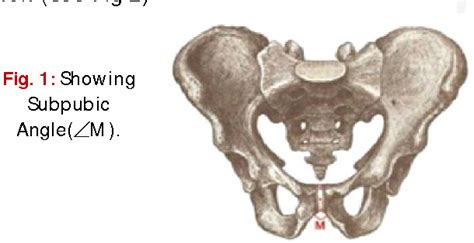 Figure 2 From Role Of Subpubic Angle In Sexual Dimorphism And Its