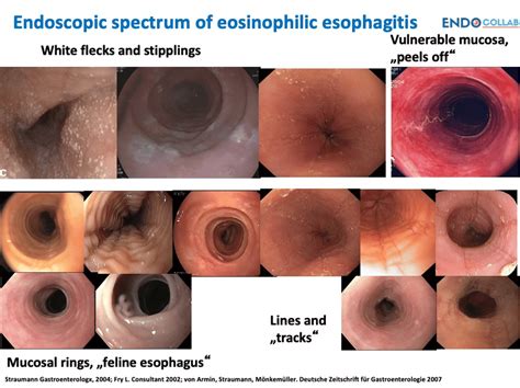 Erefs Score For Eosinophilic Esophagitis Eoe