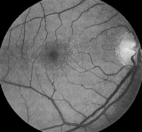 14 Age Related Macular Degeneration Ento Key