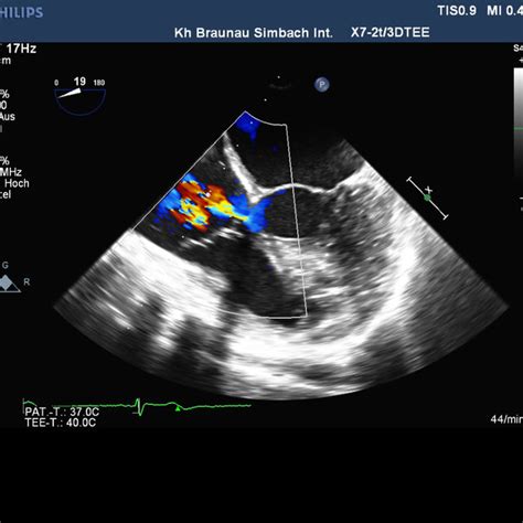 Two Dimensional Color Flow Doppler Echocardiogram Shows The Gerbode Download Scientific Diagram