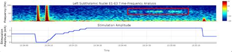 gamma band increase from stn dbs time frequency spectrogram of local
