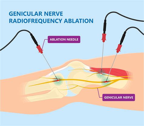 What Is A Nerve Block Orthopaedic Wellness Links
