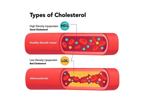 Tipos De Colesterol Comparación Con Hdl Y Ldl Valores Ilustración