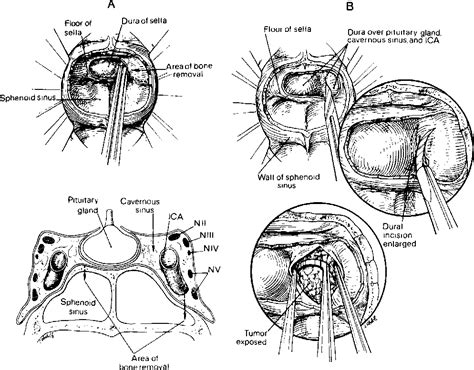Structure Of Cavernous Sinus Semantic Scholar