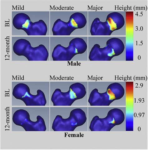 visualization of three dimensional proximal femoral bone models in
