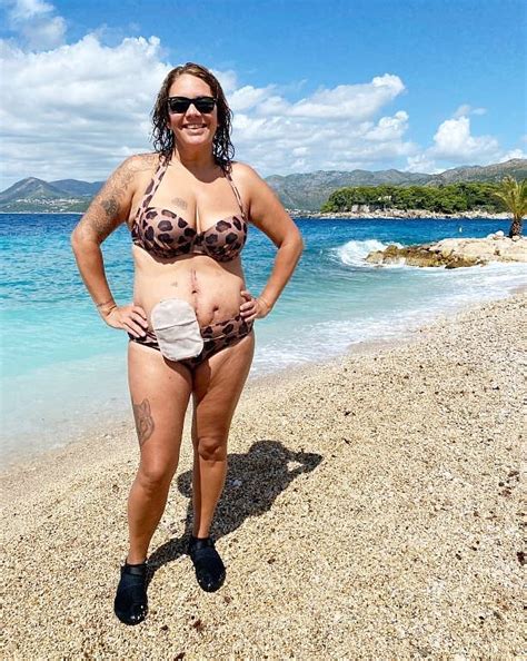 What Sex Is Like With A Stoma Bag Woman Reveals How Her Relationship