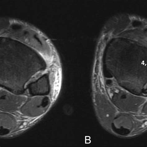 Arthroscopic Views Of The Tibiotalar Joint Showing The Asi A Download Scientific Diagram