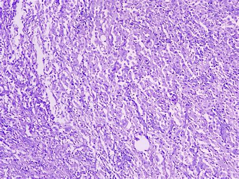 Pathology Outlines Eosinophilic Cholecystitis