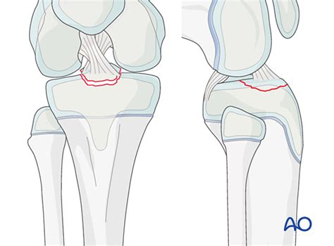 Avulsion Of The Tibial Spine