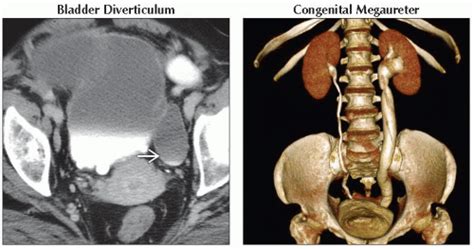Da16 Db1 Cysticdilationofdistalureter Ffu5 Abdominal Key