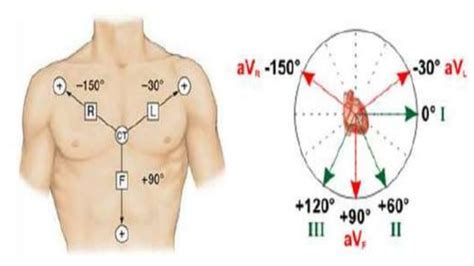 Ecg Localization Of Myocardial Infarction Pptx Heart And