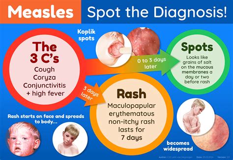 Update On Measles And Mmr Vaccine