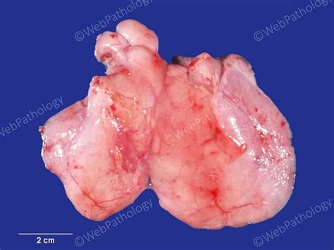 True Thymic Hyperplasia