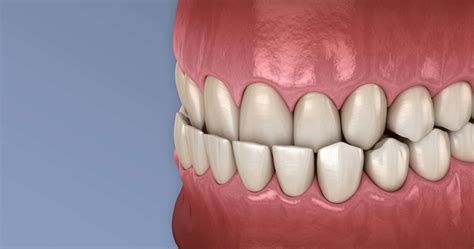 Bite Correction In San Antonio Tx Orthodontic Services