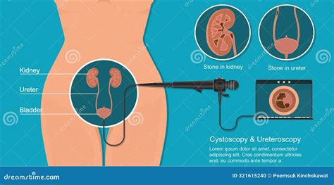During A Cystoscopy The Doctor Passes The Tube Into The Bladder Stock