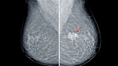 Are Breast Calcifications Cause For Concern