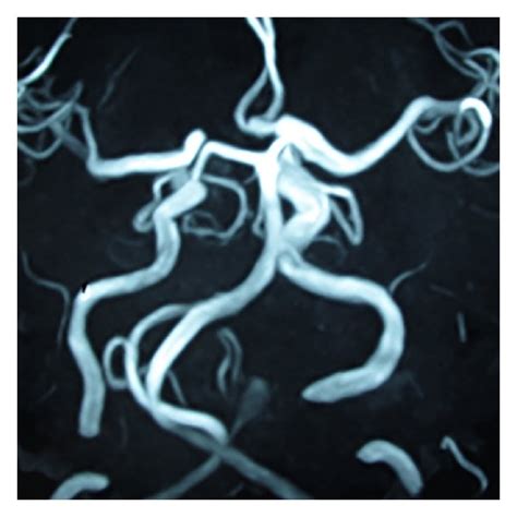 Noncontrast Enhanced Ct Brain Showing A Hyperdense Midline Lesion Of Download Scientific